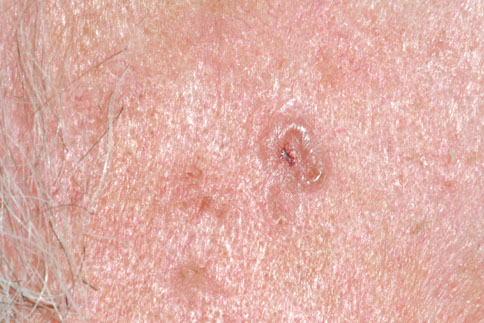 Skin Lesions Encyclopaedia
