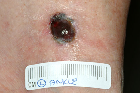 Skin Lesions Encyclopaedia