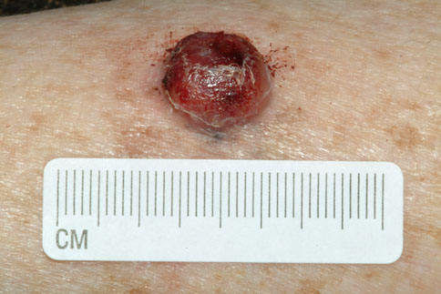 Skin Lesions Encyclopaedia