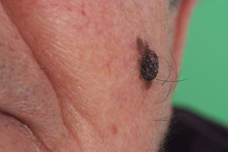 Skin Lesions Encyclopaedia