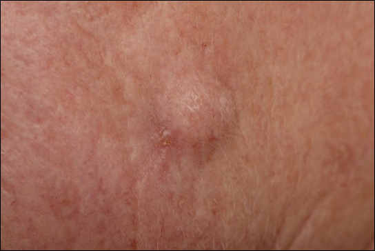Skin Lesions Encyclopaedia