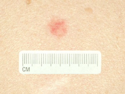 Skin Lesions Encyclopaedia