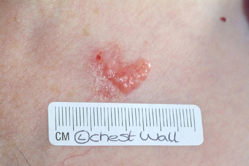 Skin Lesions Encyclopaedia