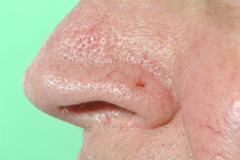 Skin Lesions Encyclopaedia