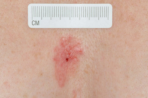 Skin Lesions Encyclopaedia