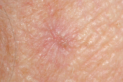 Skin Lesions Encyclopaedia