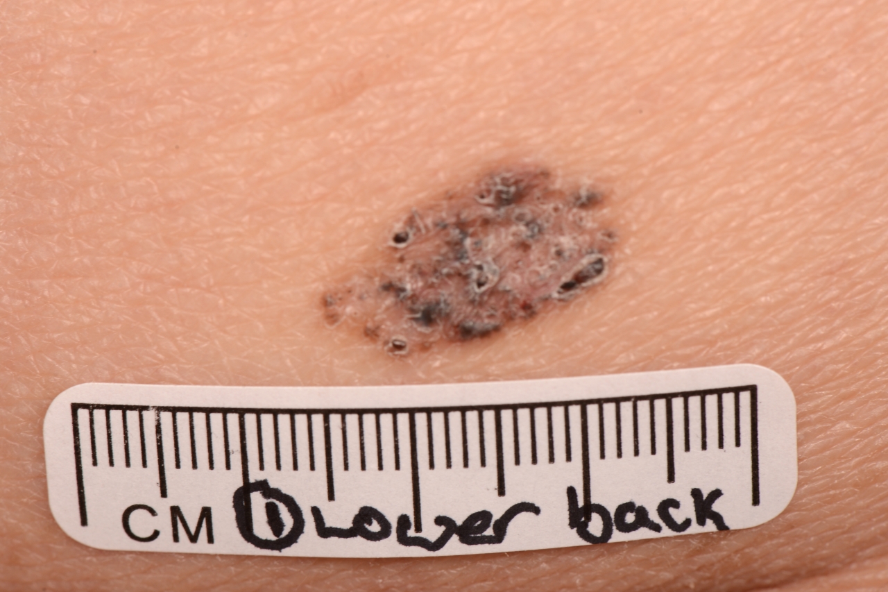 Skin Lesions Encyclopaedia