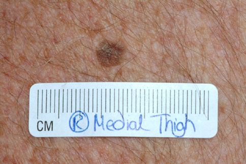 Skin Lesions Encyclopaedia