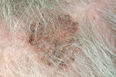Skin Lesions Encyclopaedia