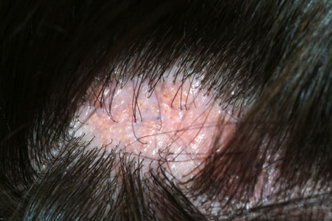 Skin Lesions Encyclopaedia