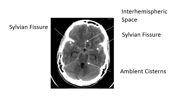 Interhemispheric Space Sylvian Fissure Ambient Cisterns Prepontine Cisterns