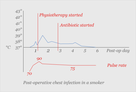 Post-operative Pneumonia