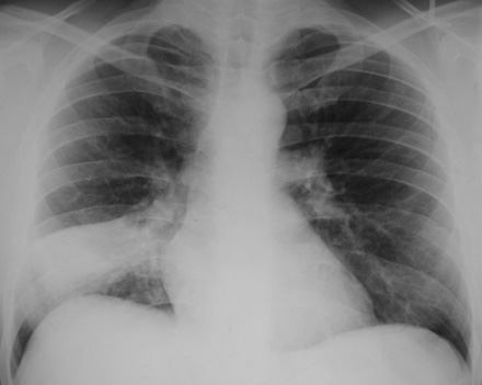 Post-operative chest infection in a smoker