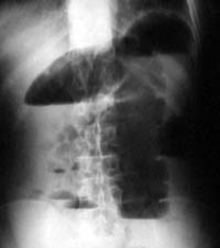 Surgery Large Bowel Obstruction 1 Carcinoma Of Colon And Diverticular ...