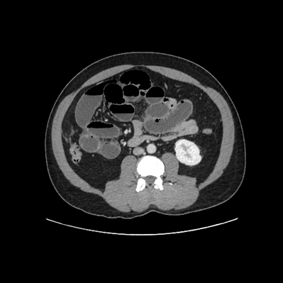 Surgery Small Bowel Obstruction