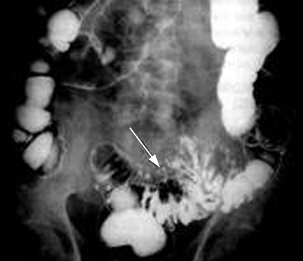 Figure 3 - Barium enema demonstrating multiple sigmoid diverticulae.