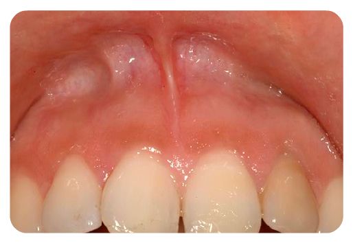 Central Sulcus Of Tongue