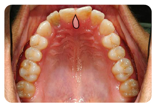 Swollen Soft Palate