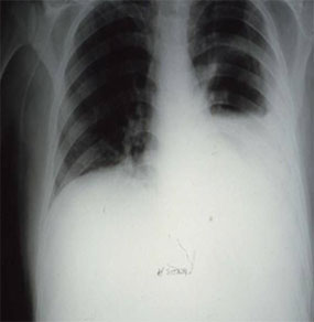 Chest PA radiograph