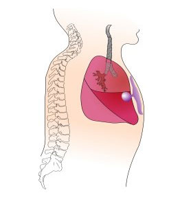Pathogenesis of empyema from a right middle lobe lung abscess rupturing ...
