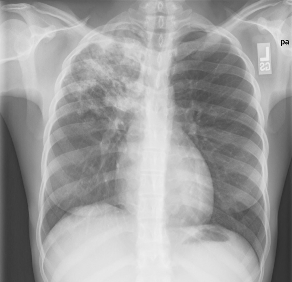 Chest Xray Tb