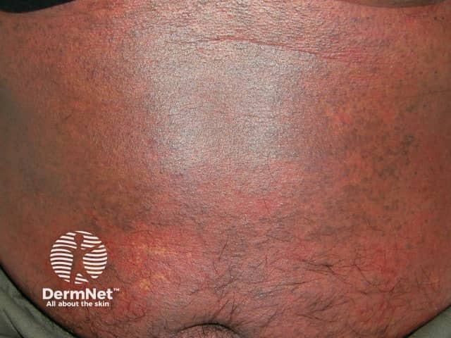 Viral Exanthema 1 - A Woman with a Morbilliform Rash